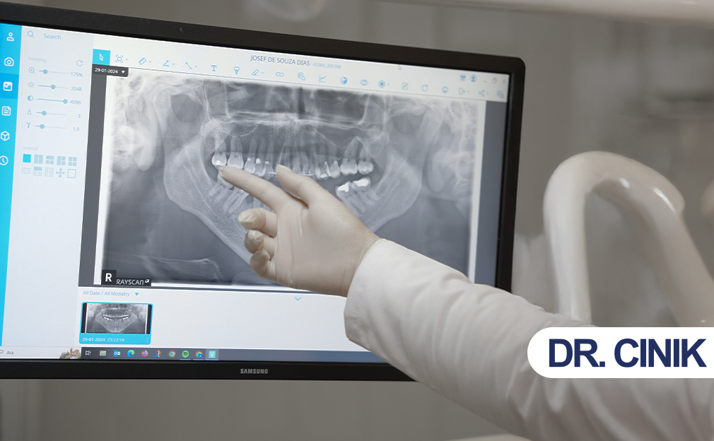 How much Dental implant costs in Turkey - Cinik Dental